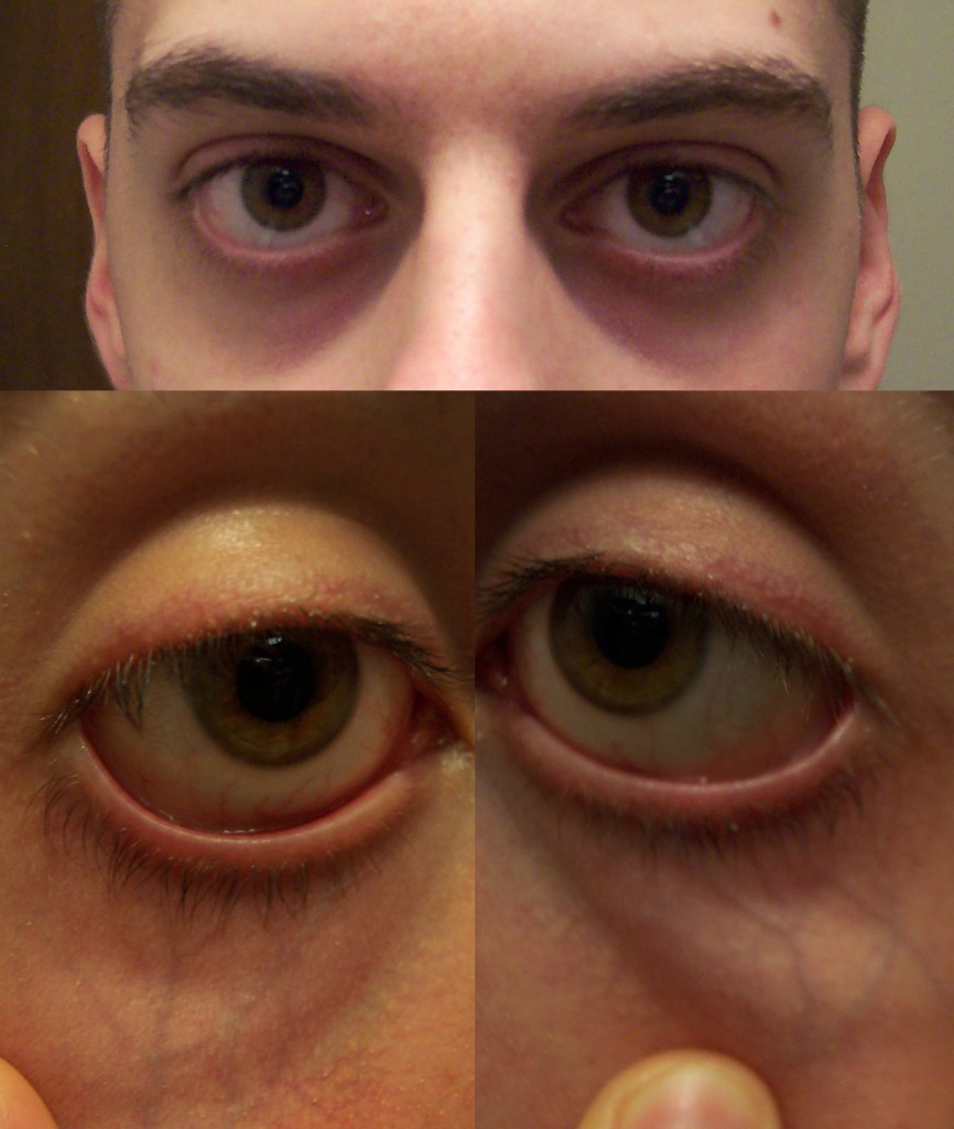 What Causes Dark Circles Under Eyes 